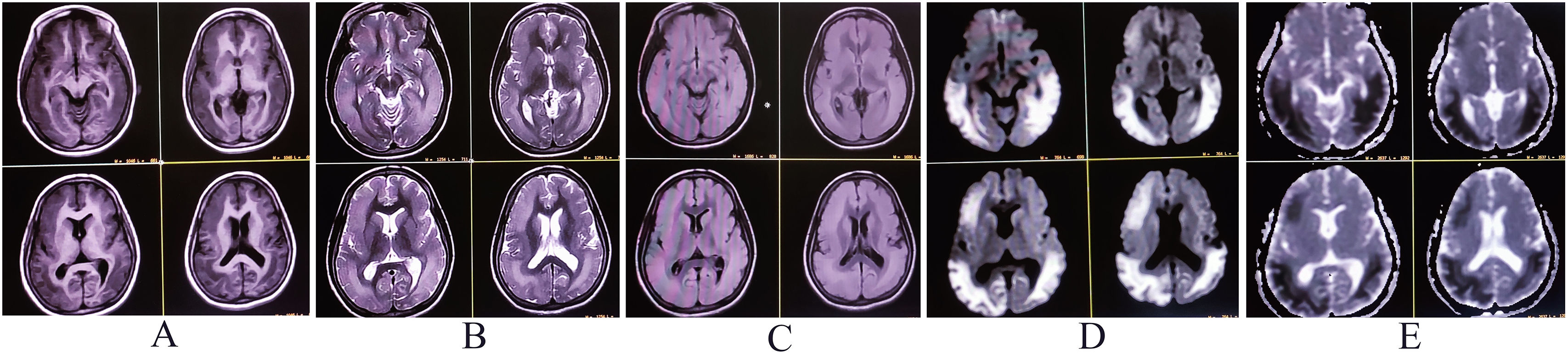 Bálint syndrome in a patient with drug-resistant epilepsy having ...