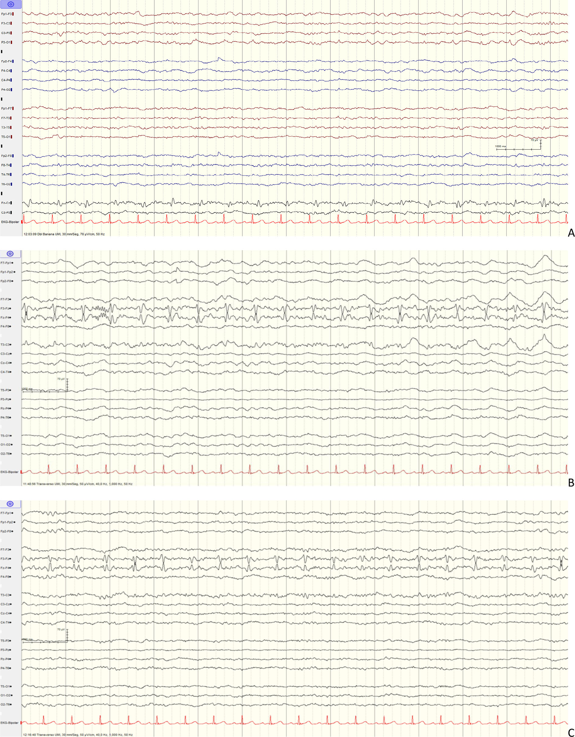 Cerebrospinal fluid pulse: A new EEG artefact | Neurology perspectives