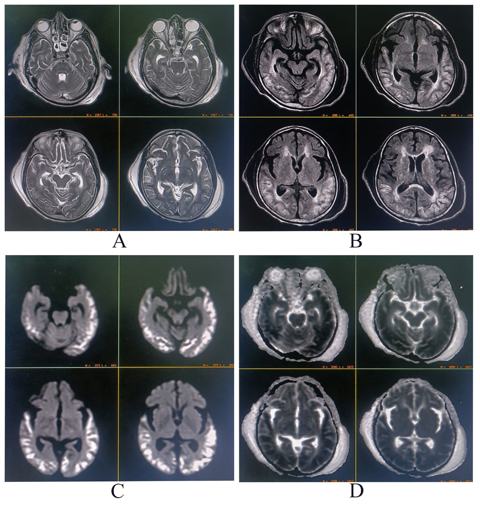 A novel case of Bálint syndrome with hallucinatory palinopsia following ...