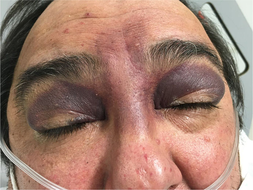 ecchymosis eye