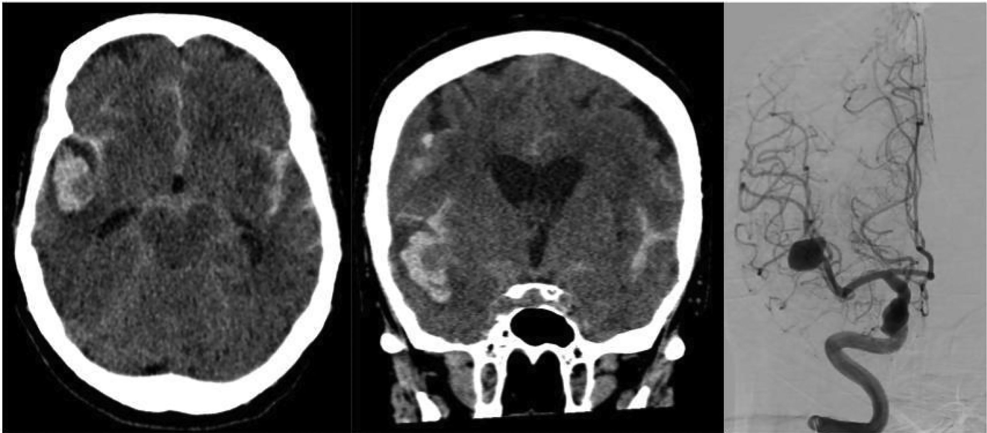 Update on diagnosis and treatment of aneurysmal subarachnoid hemorrhage ...