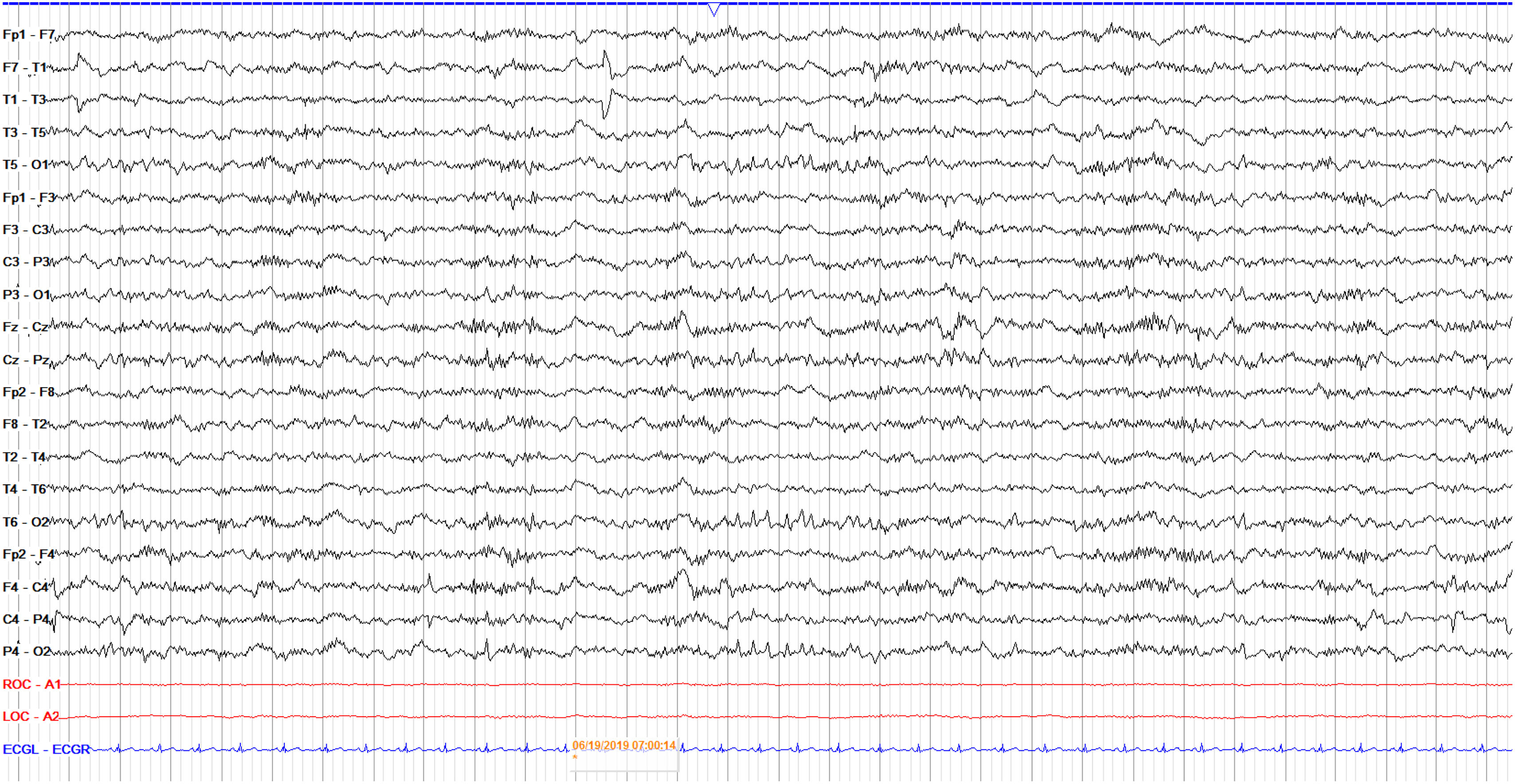 Paroxysmal tonic upgaze with epileptiform discharges and calcarine ...